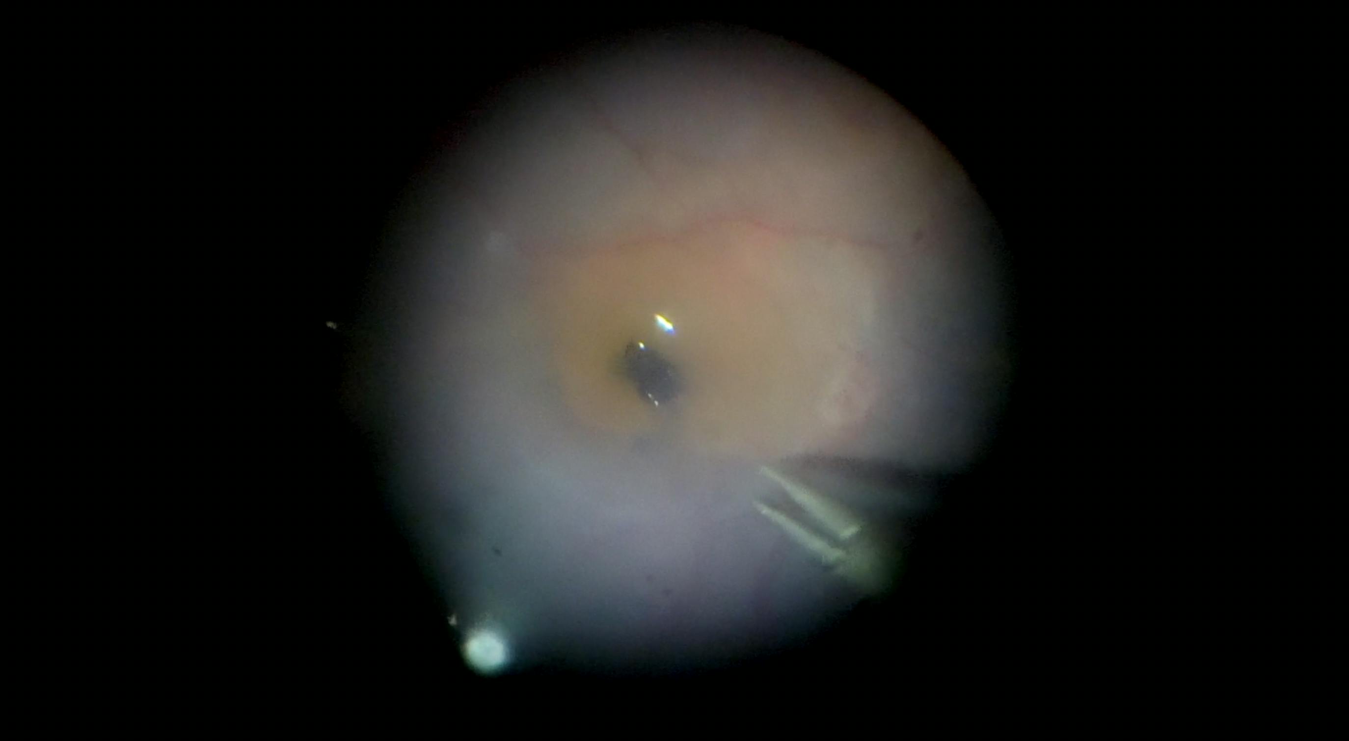 Inverted ILM Flap for Traumatic Macular Hole With PVR Retinal ...