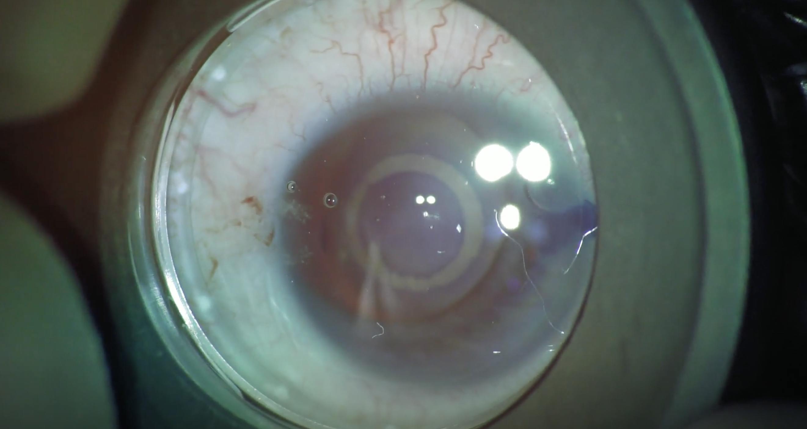 Intumescent Cataract Surgery With CapsuLaser - Eyetube