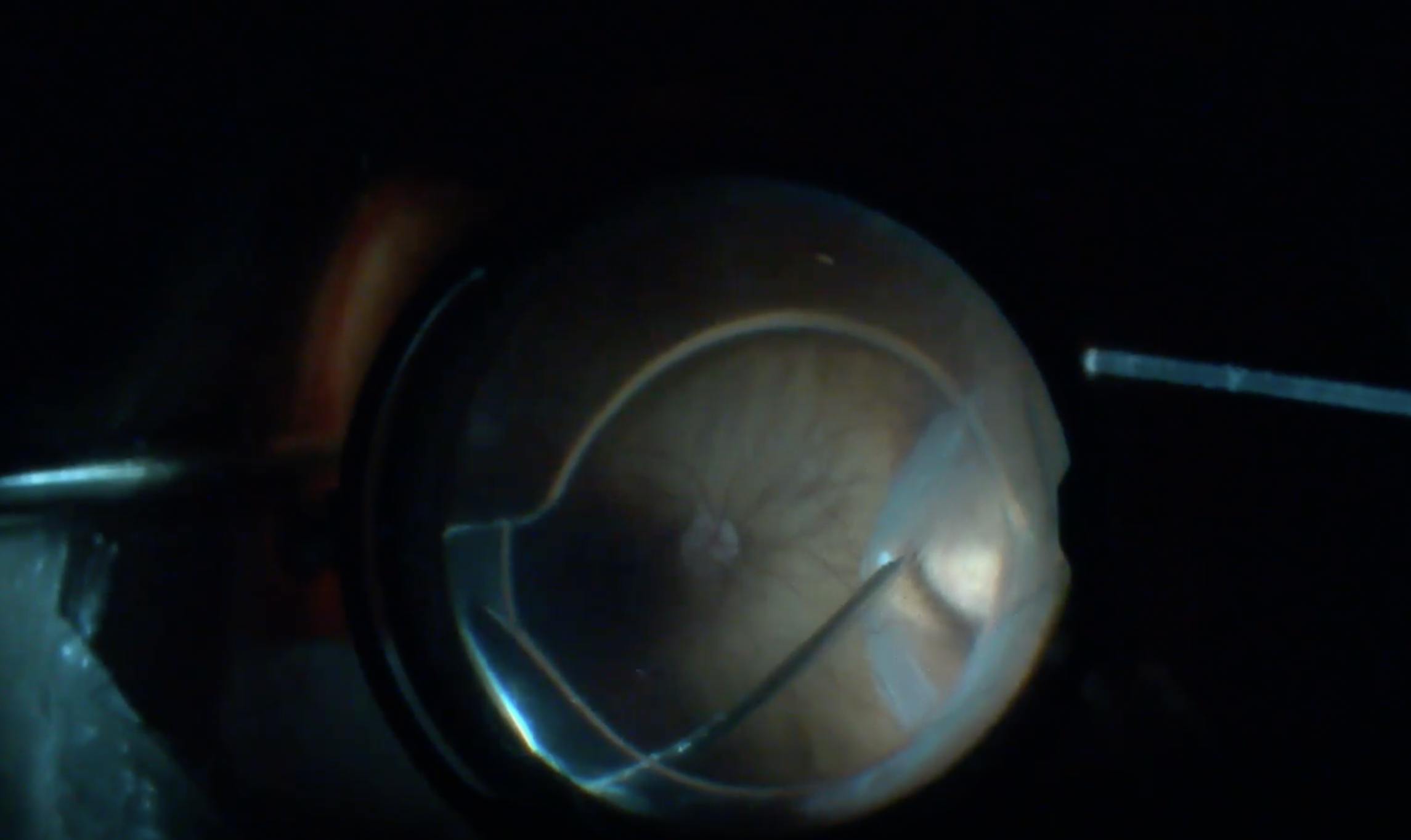 Management of Localized Retinal Detachment Without PFO - Eyetube