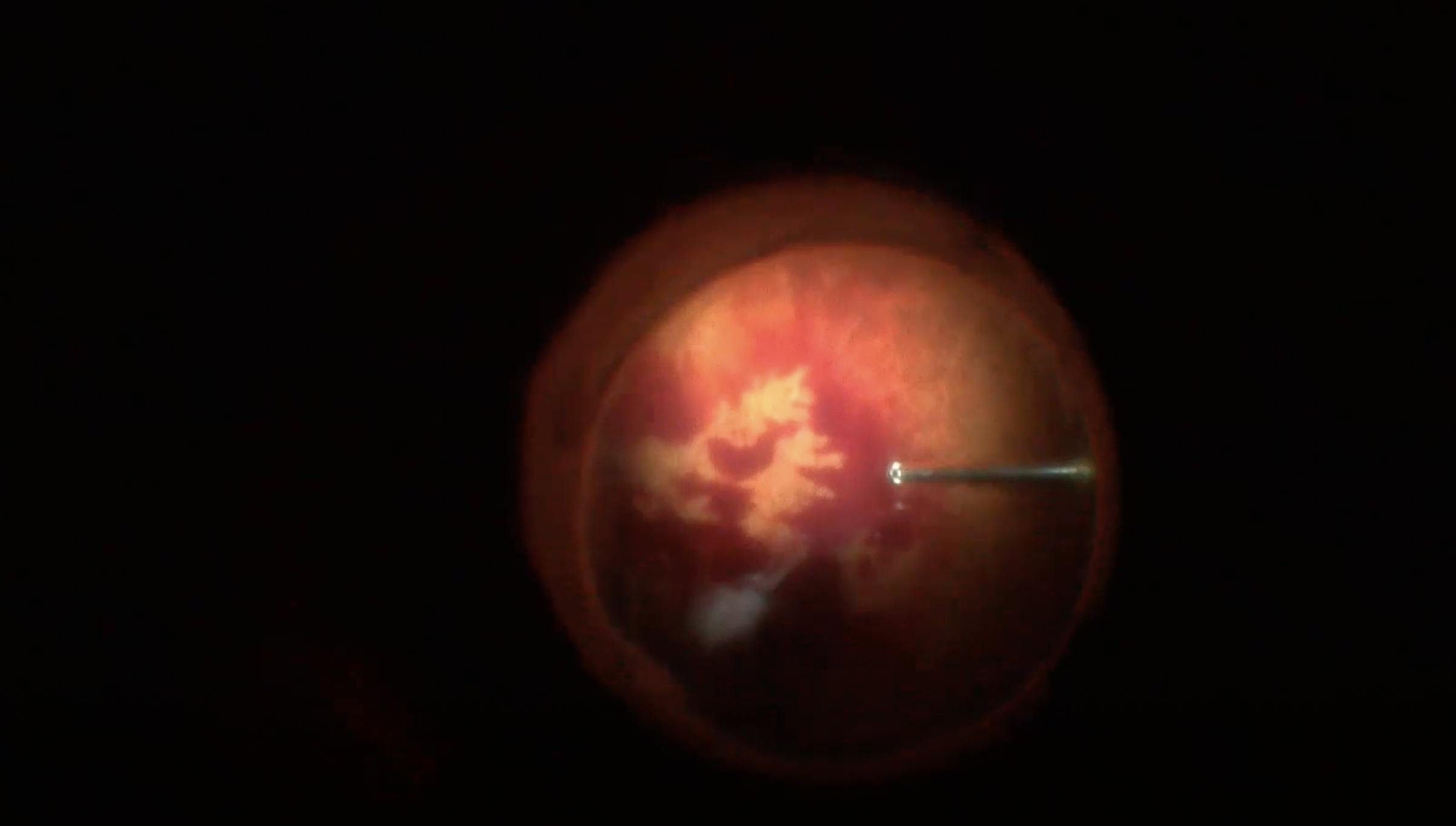Severe PDR With Macular Folds - Eyetube