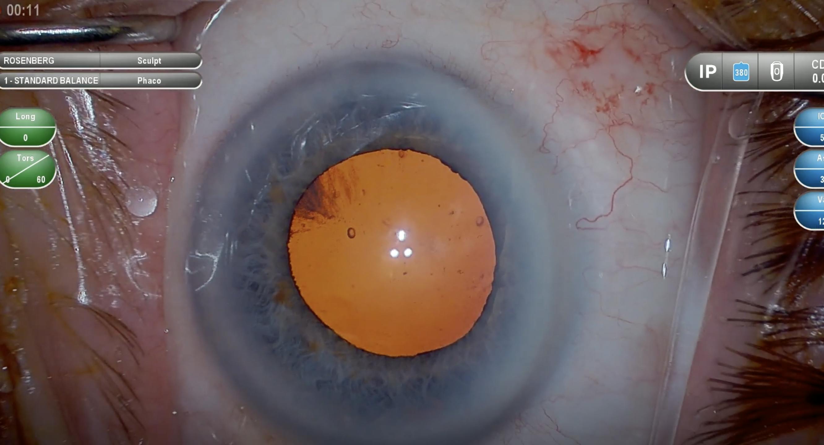 Posterior Capsular Rupture - Eyetube