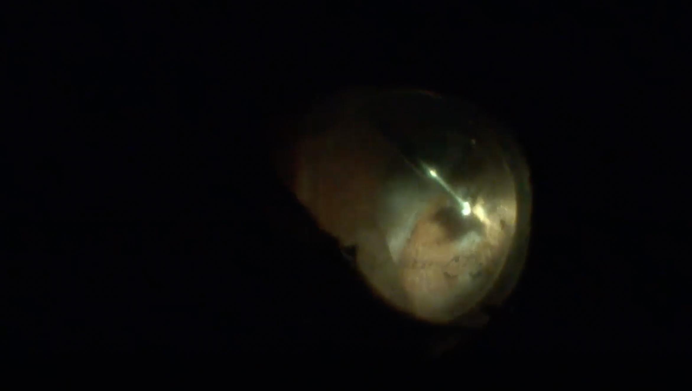 PVR Retinal Detachment With Hemorrhagic Choroidals and Hypotony - Eyetube