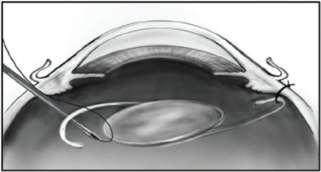 14 Tips for Scleral Suturing For Any IOL - Retina Today