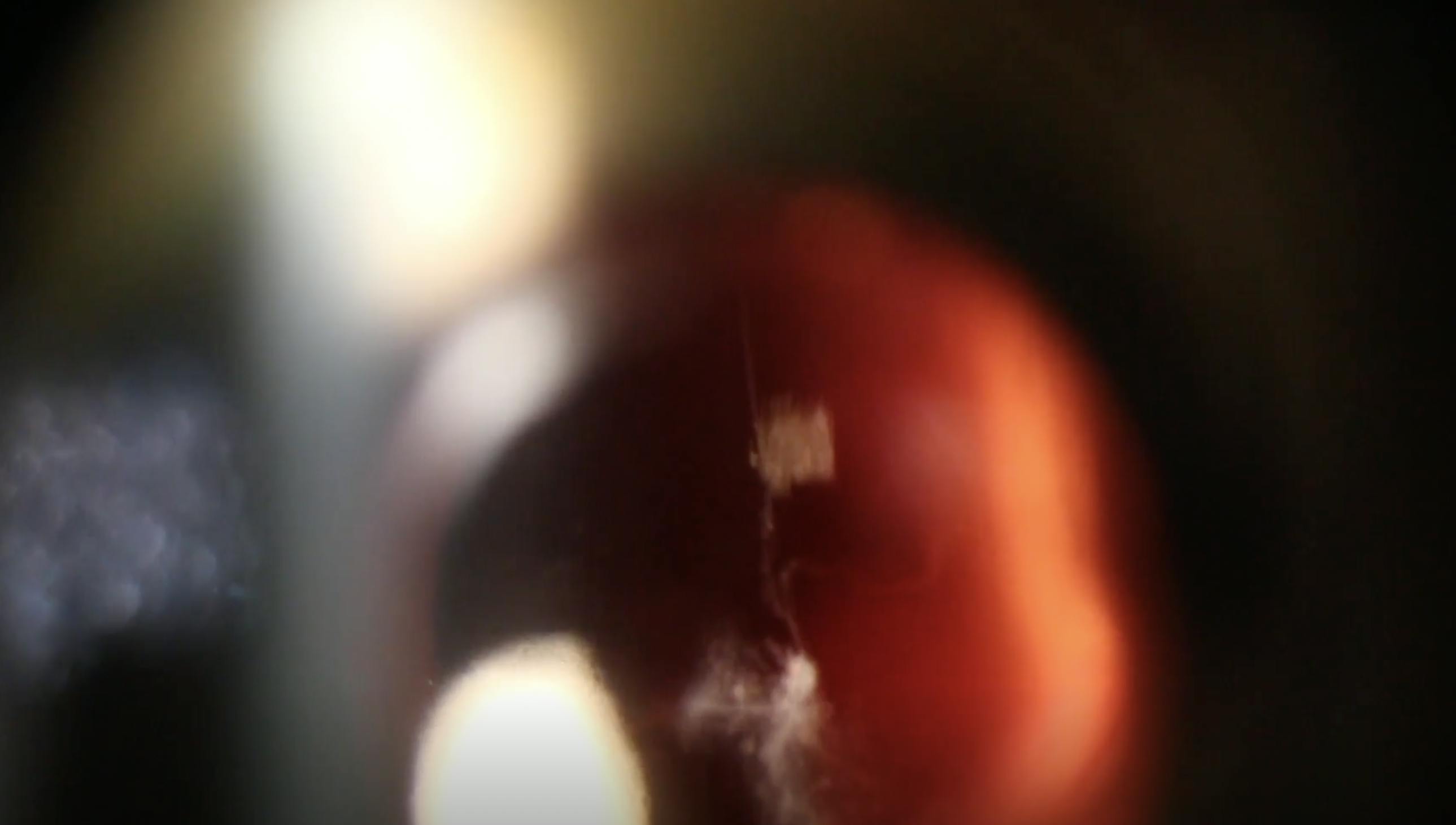 Laser Floater Treatment: Using Reflex Technology to Visualize the ...