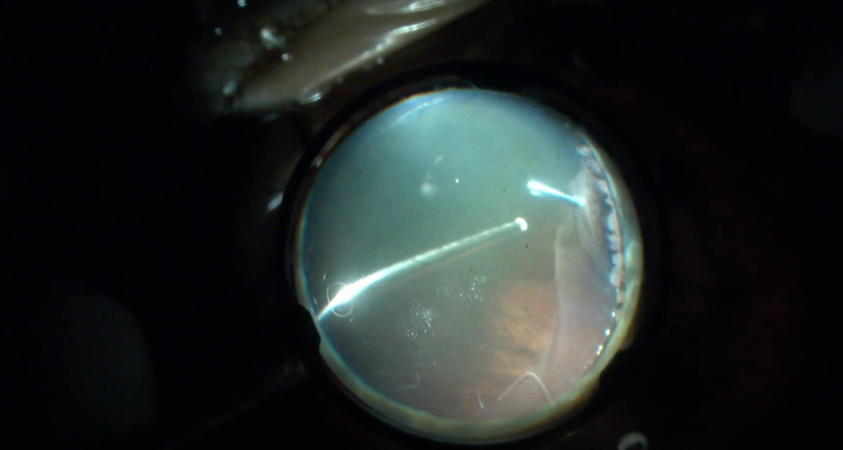 Management of Subretinal Trocar During Vitrectomy for Retinal ...