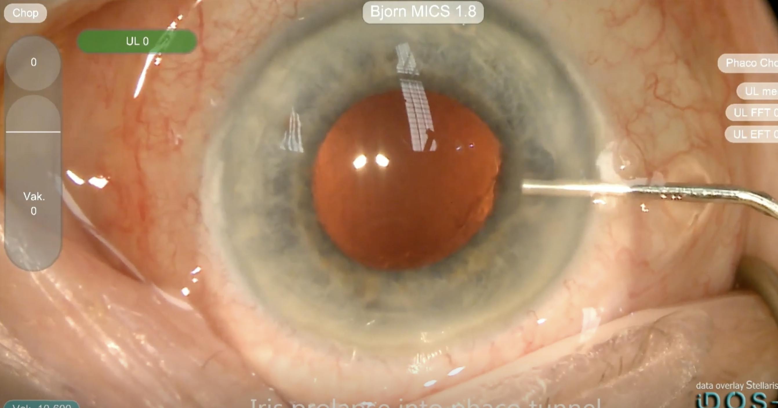 Battle With a Suprachoroidal Hemorrhage - Eyetube