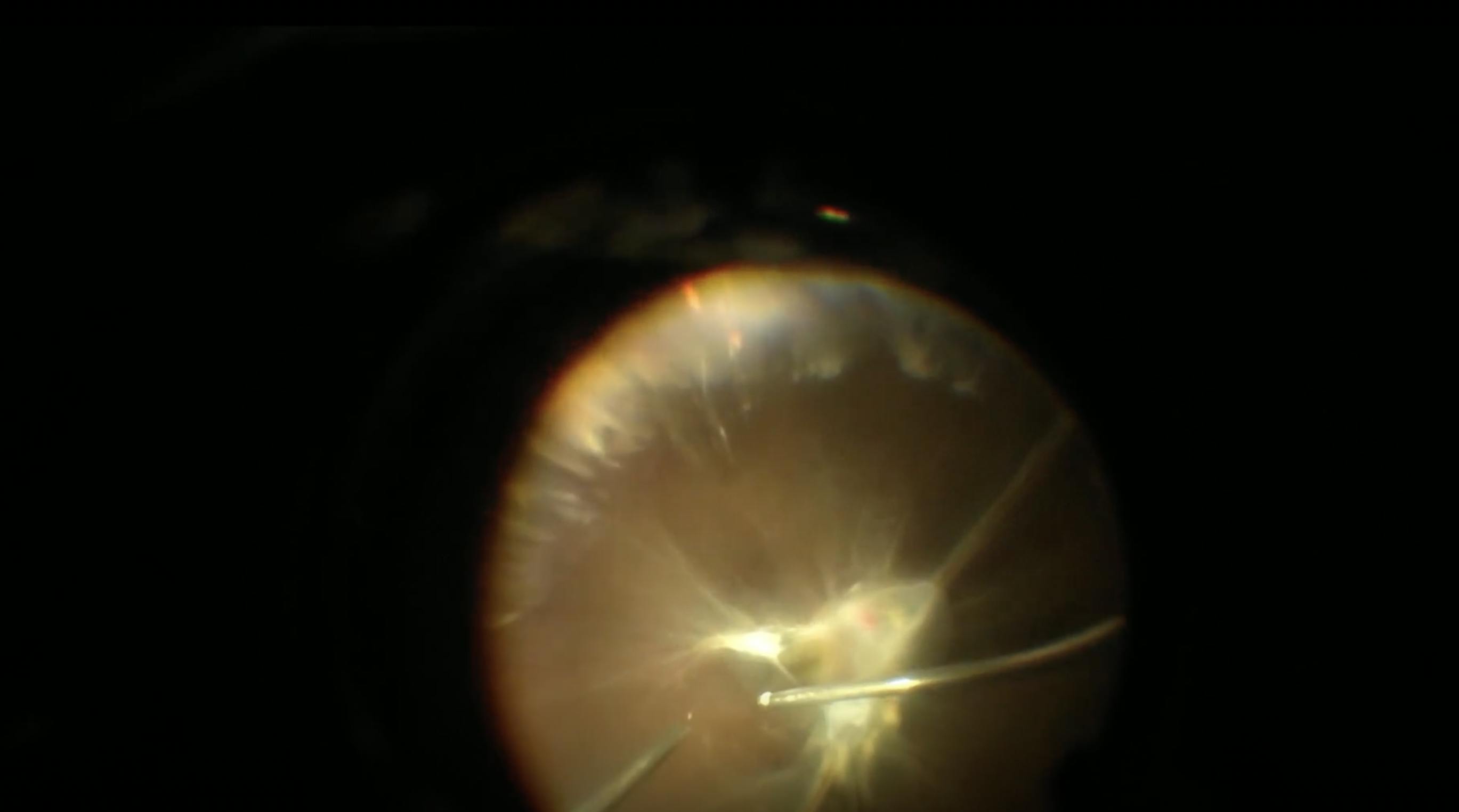 Advanced Traction Retinal Detachment Repair in a Patient With ...