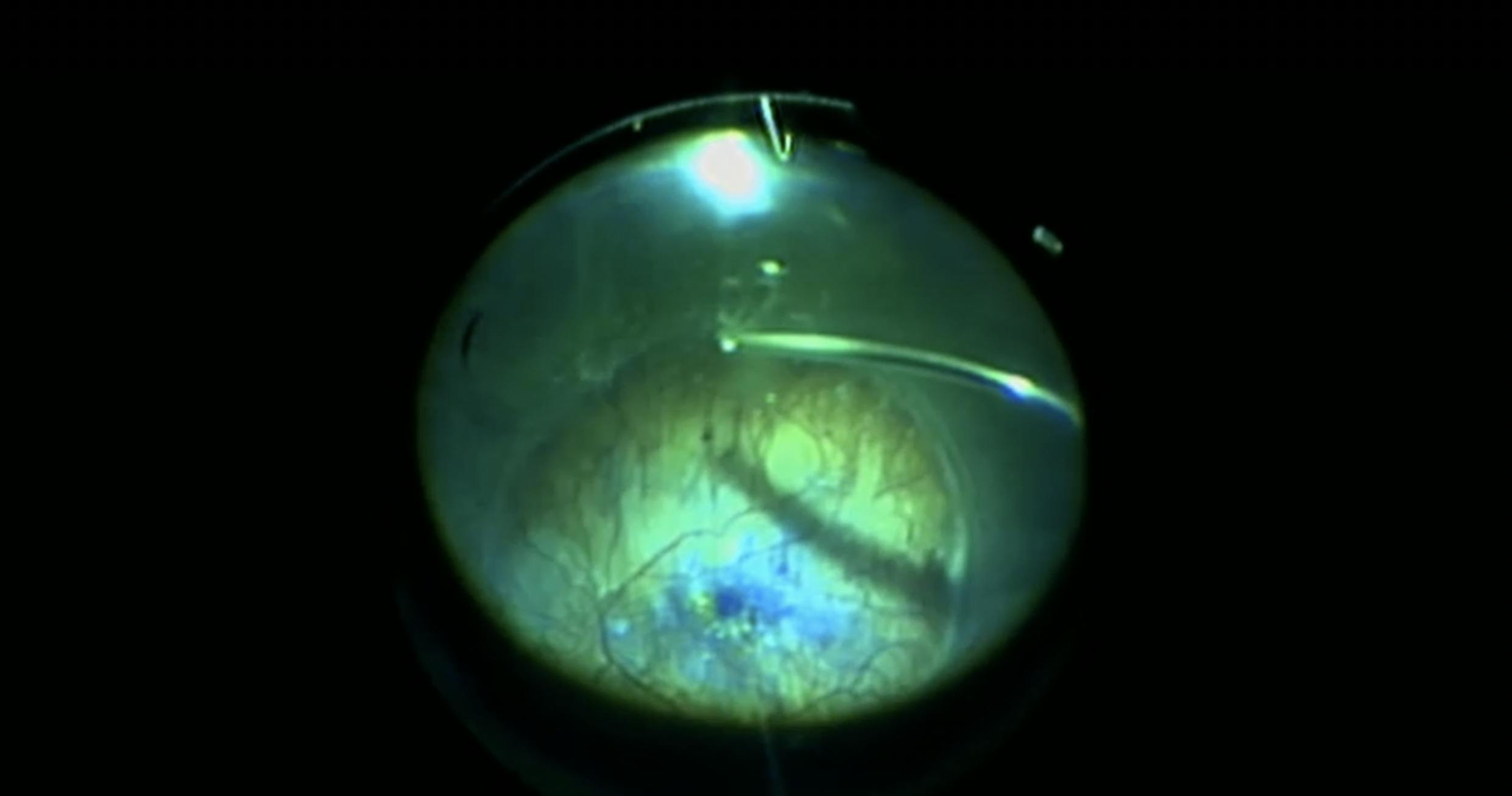 Macular Hole—Related Retinal Detachment in High Myopia - Eyetube