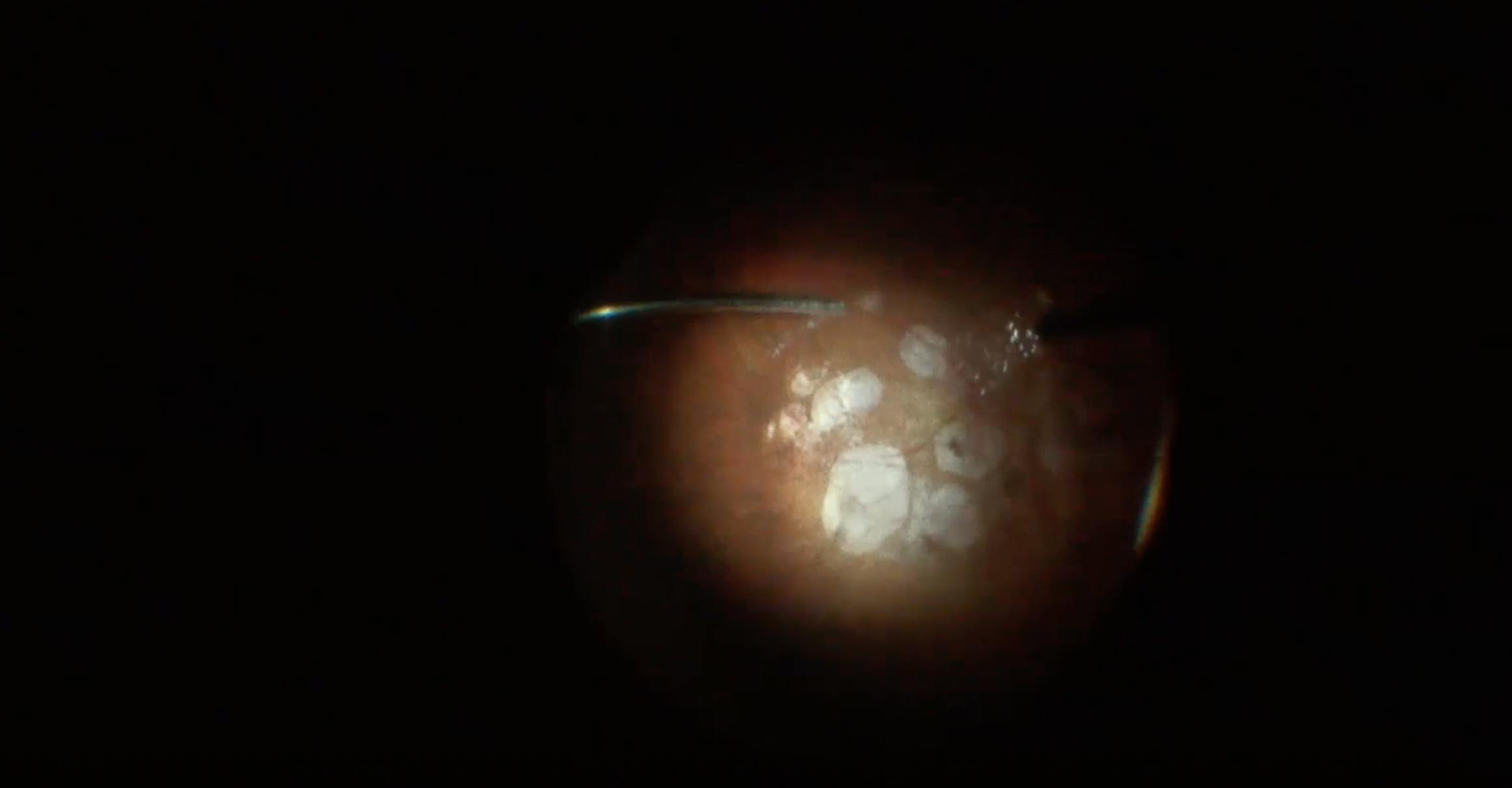 Myopic Maculoschisis - Eyetube