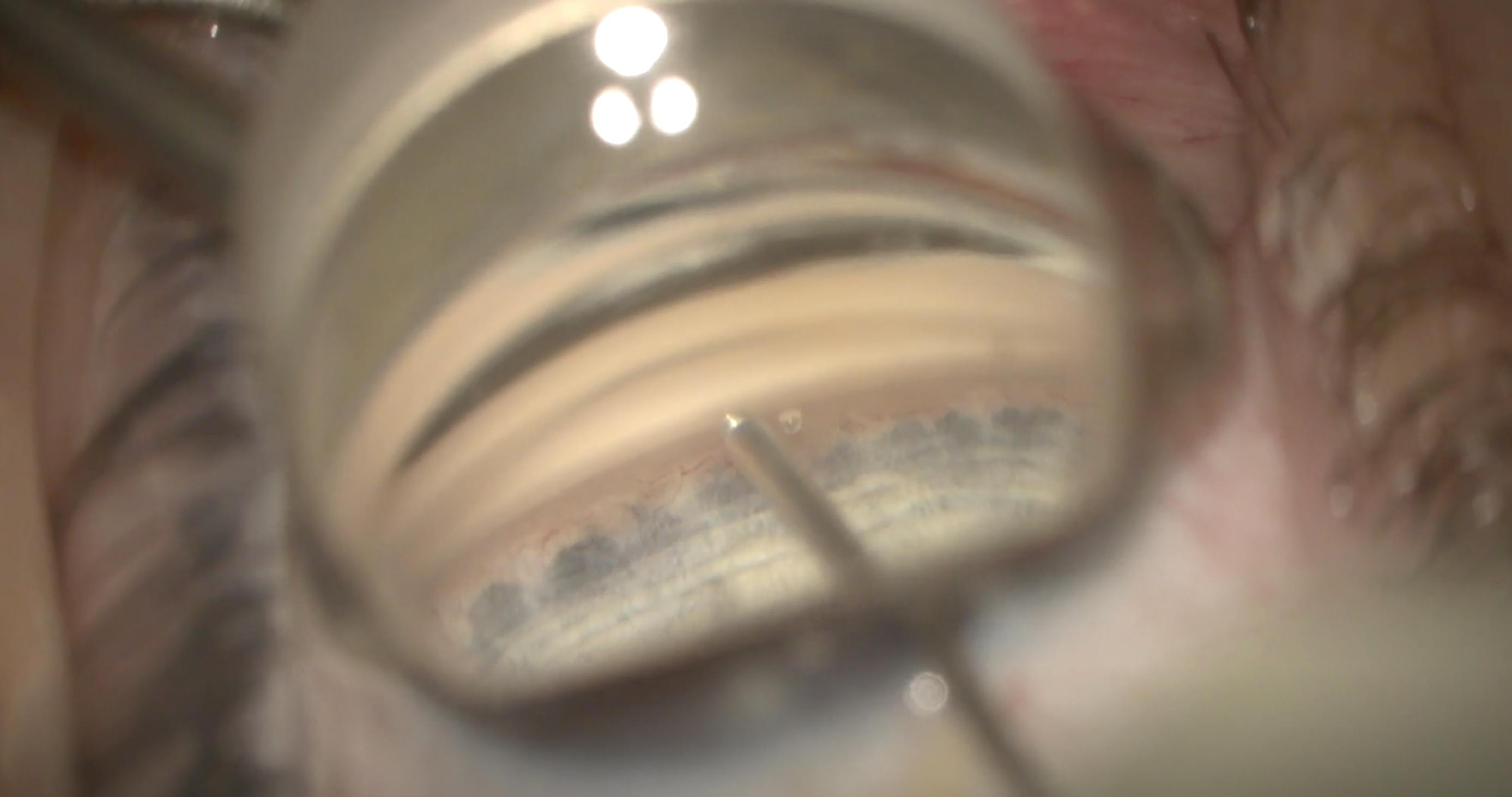 iStent Infinite® Surgery - Eyetube