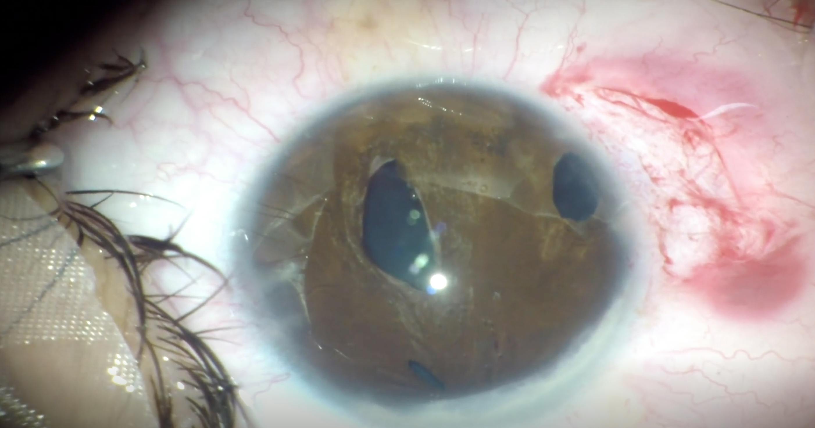 Pupilloplasty in Eye With Axenfeld-Rieger Syndrome - Eyetube