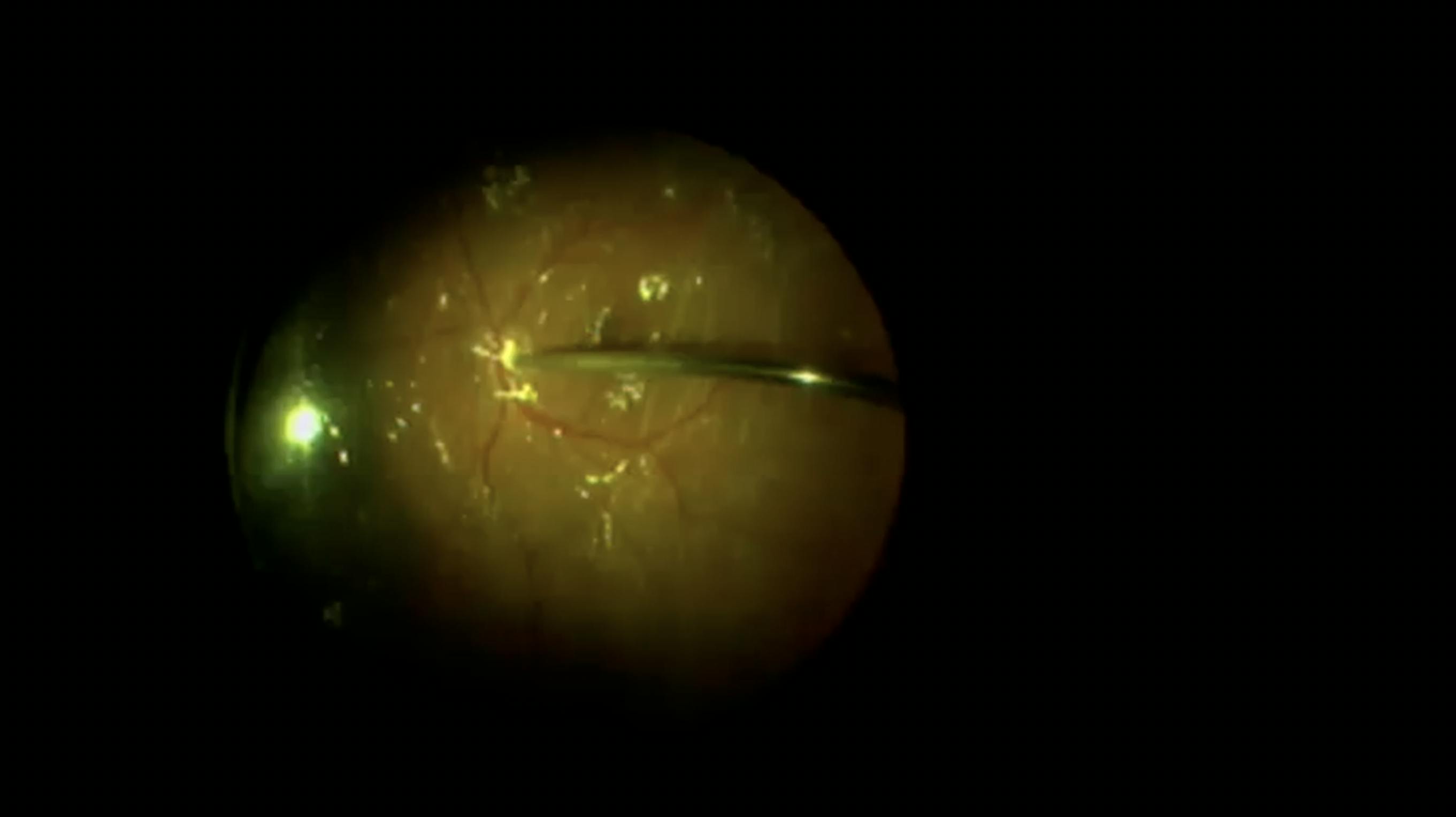 Giant Retinal Tear Repair - Eyetube