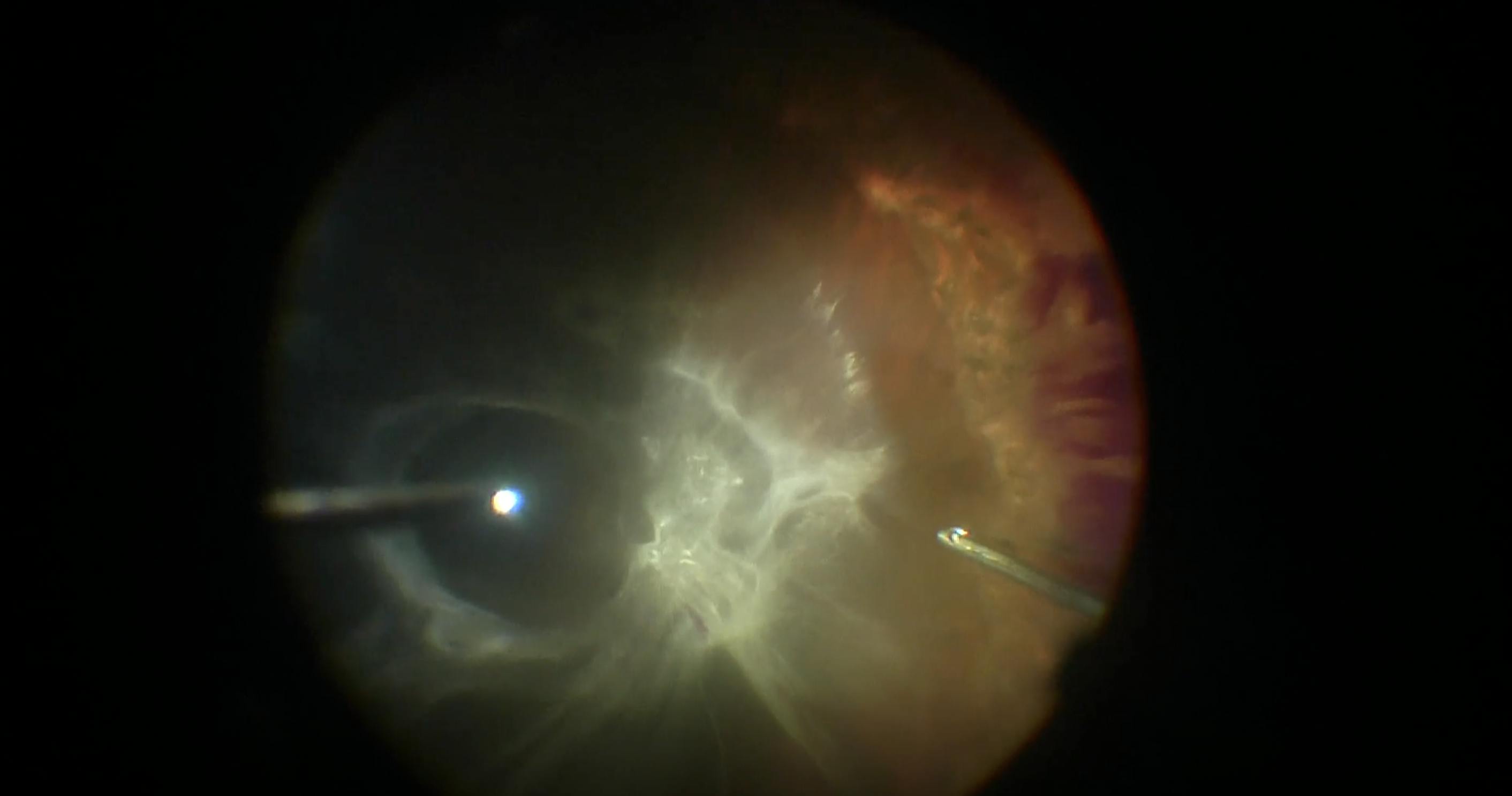 Chronic Combined Diabetic TRD and RRD - Eyetube