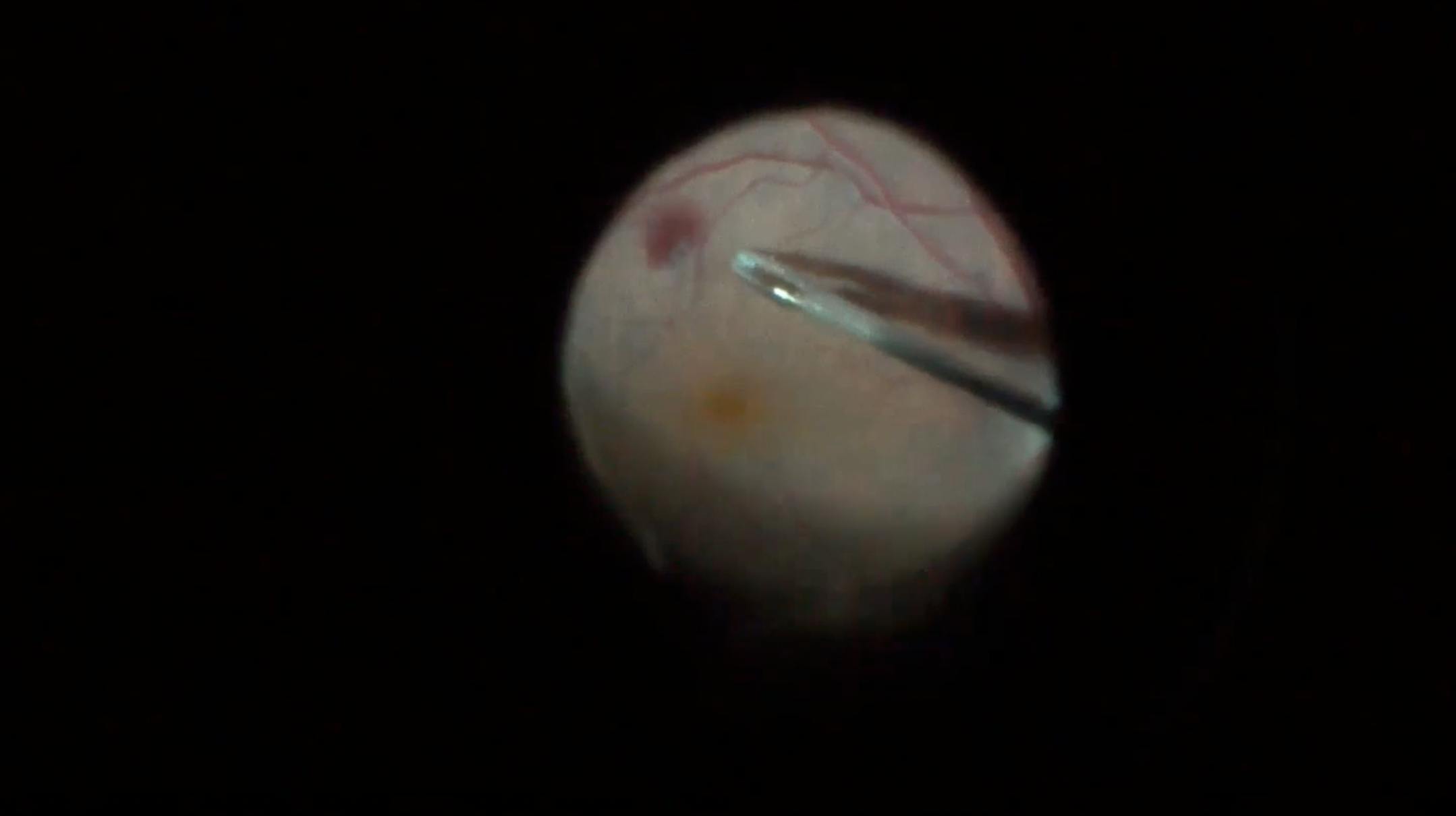 Restoration of Foveal Contour After ERM Surgery - Eyetube