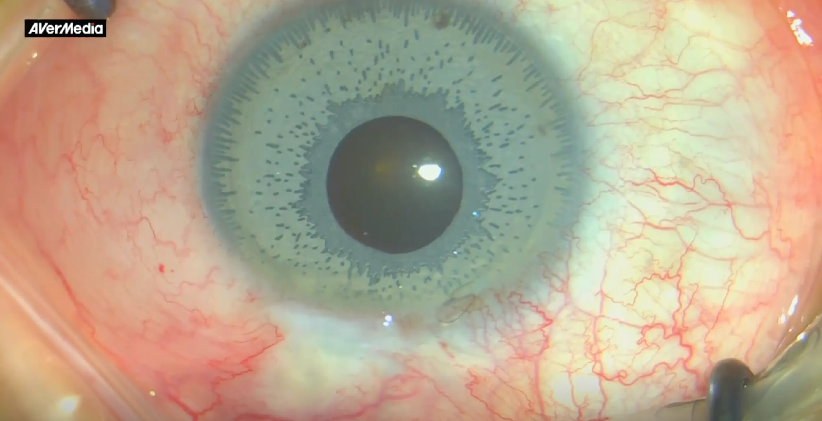 Colored Iris Implant Disaster - Eyetube