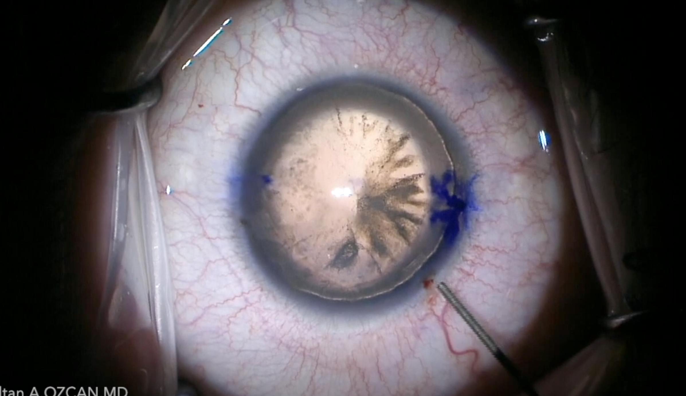 Management of Congenital Aniridia With Cataract - Eyetube
