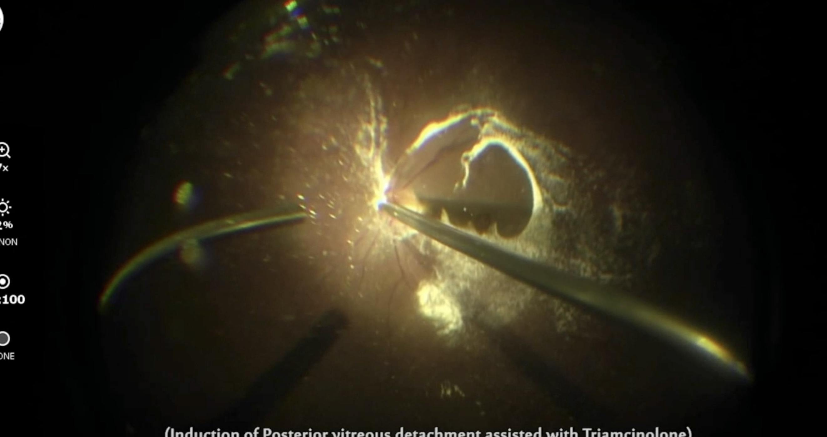 Amniotic Membrane Patch Combined With ILM Inverted Flap - Eyetube