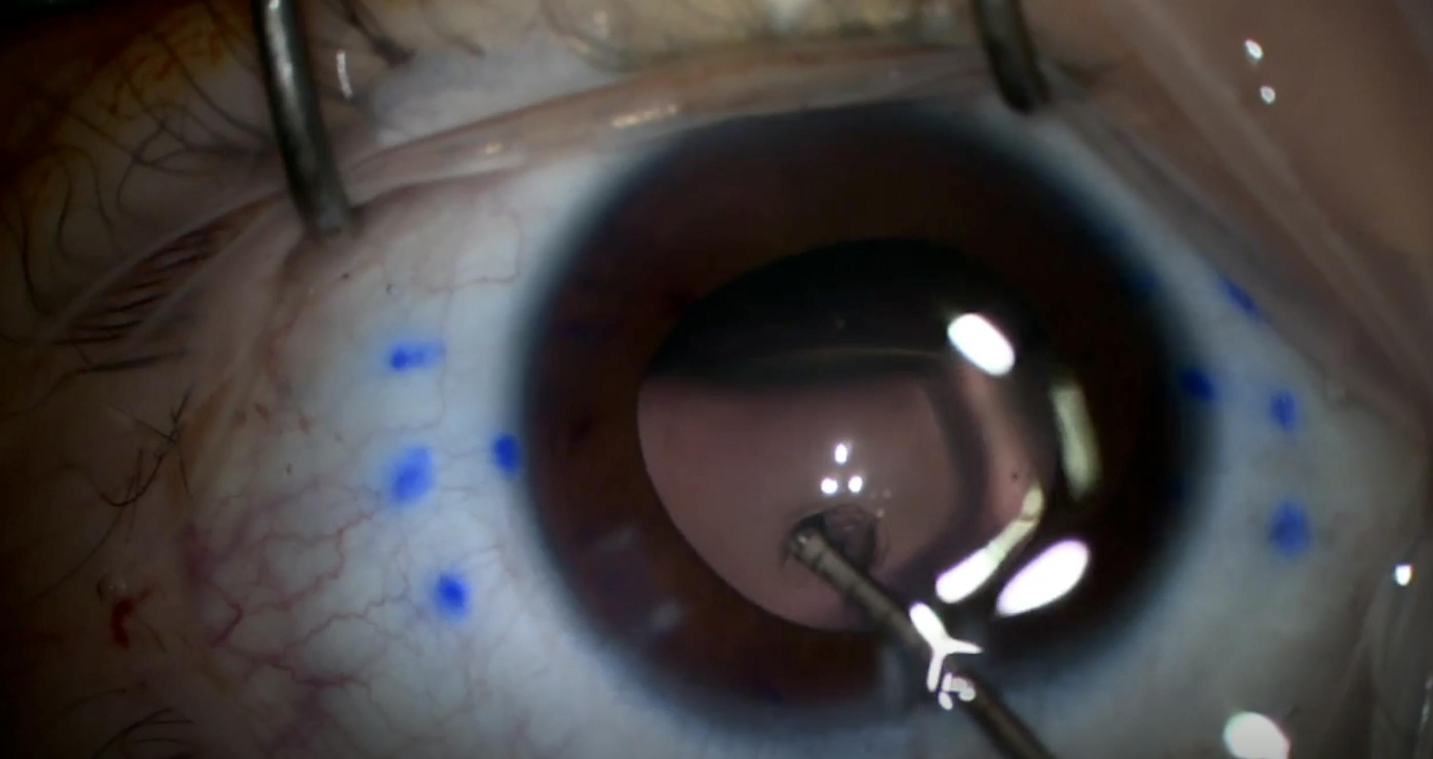 Combined Scleral-Fixated IOL and 360-Degree Trabeculotomy - Eyetube