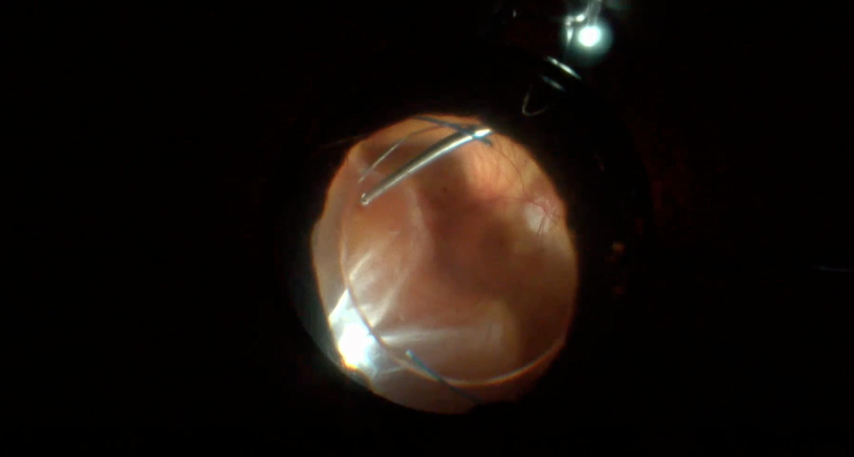 Long-Standing Choroidal Detachment Following Myopic Retinal Detachment ...