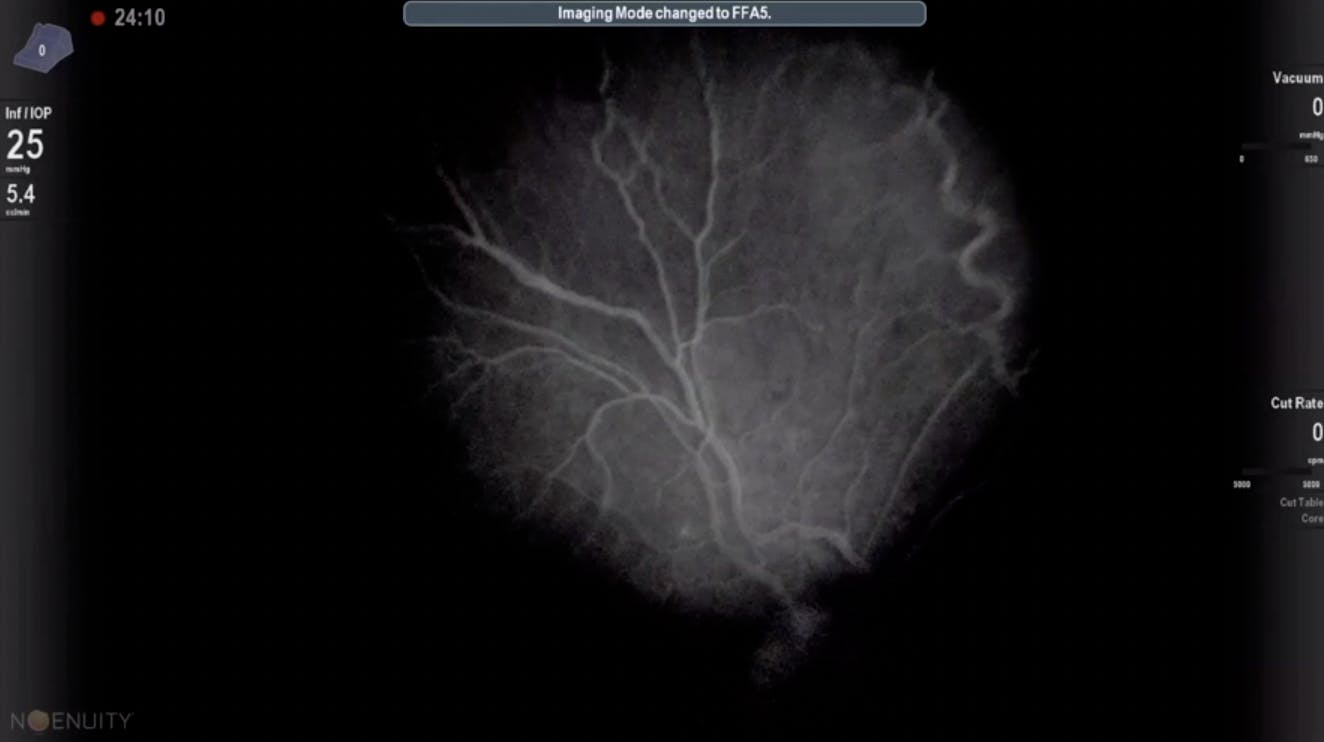 3D Intraoperative Angioscopy - Eyetube