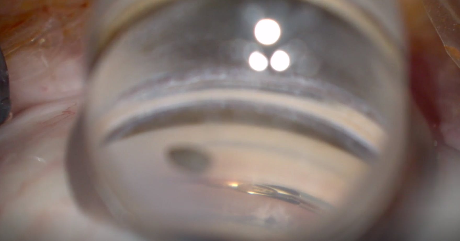 Hydrus Microstent Implantation - Eyetube