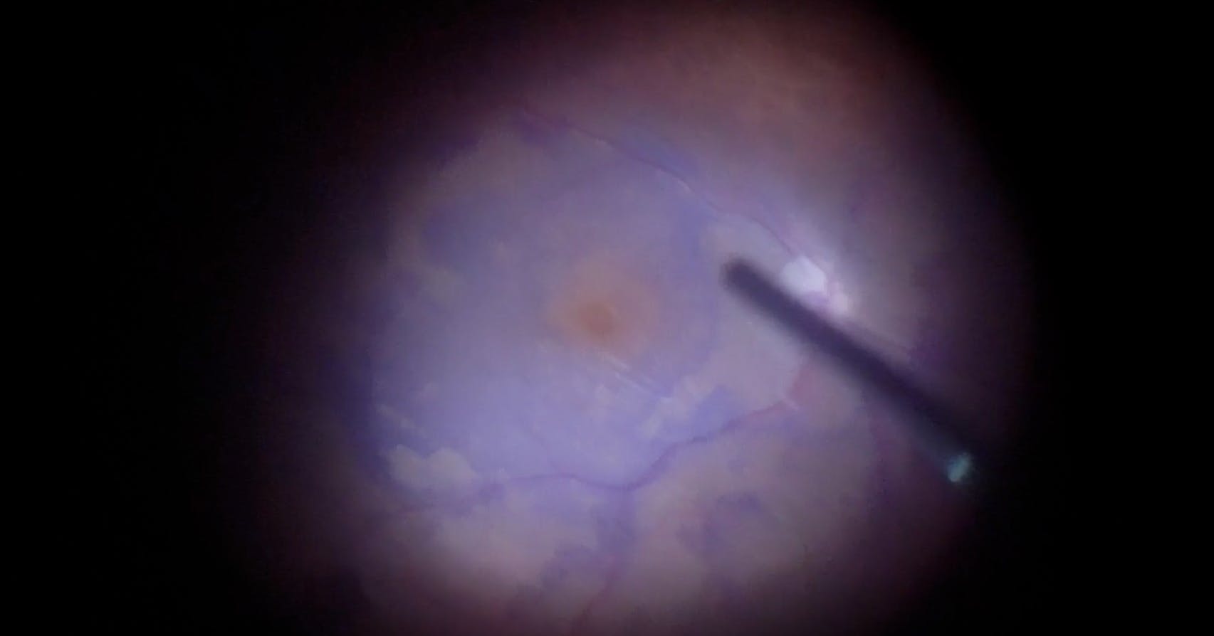 Double Peel for Taut Epiretinal Membrane With ILM Peel Under Brilliant ...