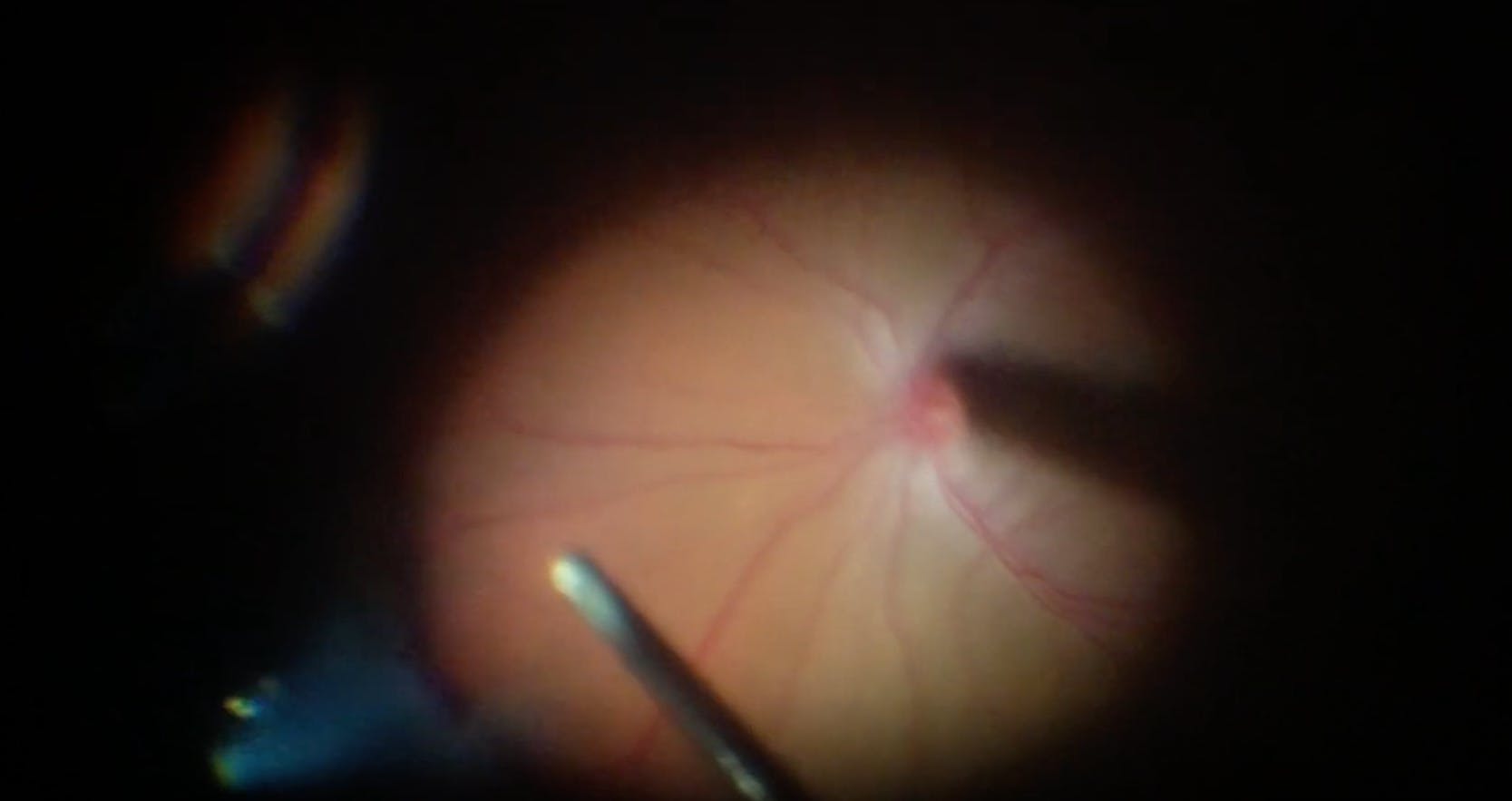 Minimally Invasive Phakic Macula-On Retinal Detachment - Eyetube