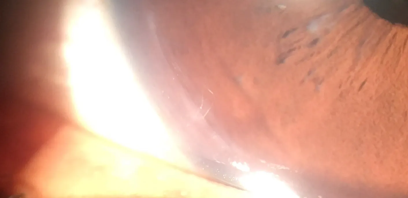 Removal of Intraocular Fiber - Eyetube