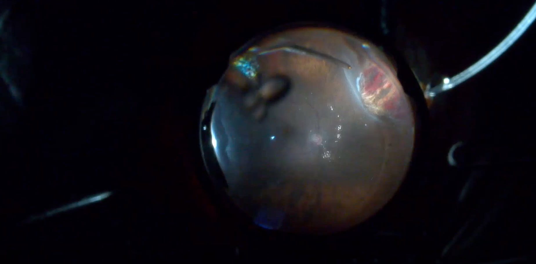 Secondary Filtration-Related Cryopexy Scar - Eyetube