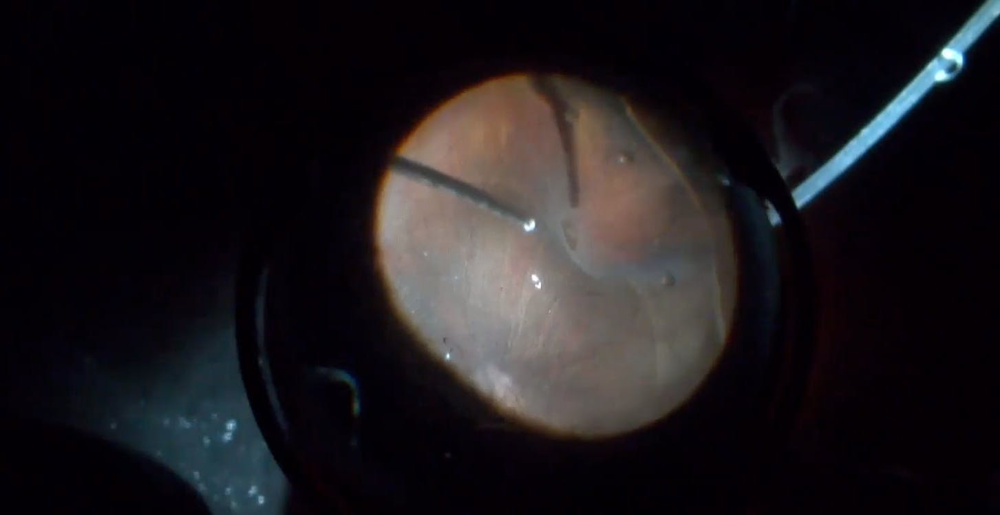PVR Retinal Detachment With Poor Functional Outcome - Eyetube