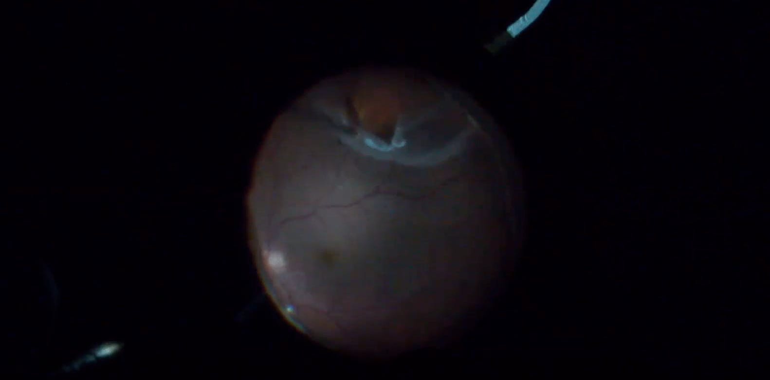 Retinal Detachment With PVR Stage B - Eyetube