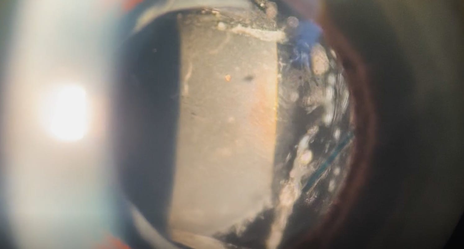 Calcified Silicone IOL Exchange - Eyetube
