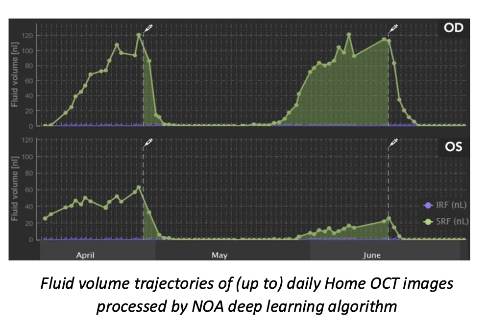 Notal Vision: Clinical Trials Demonstrate Value of Home OCT - Eyewire+