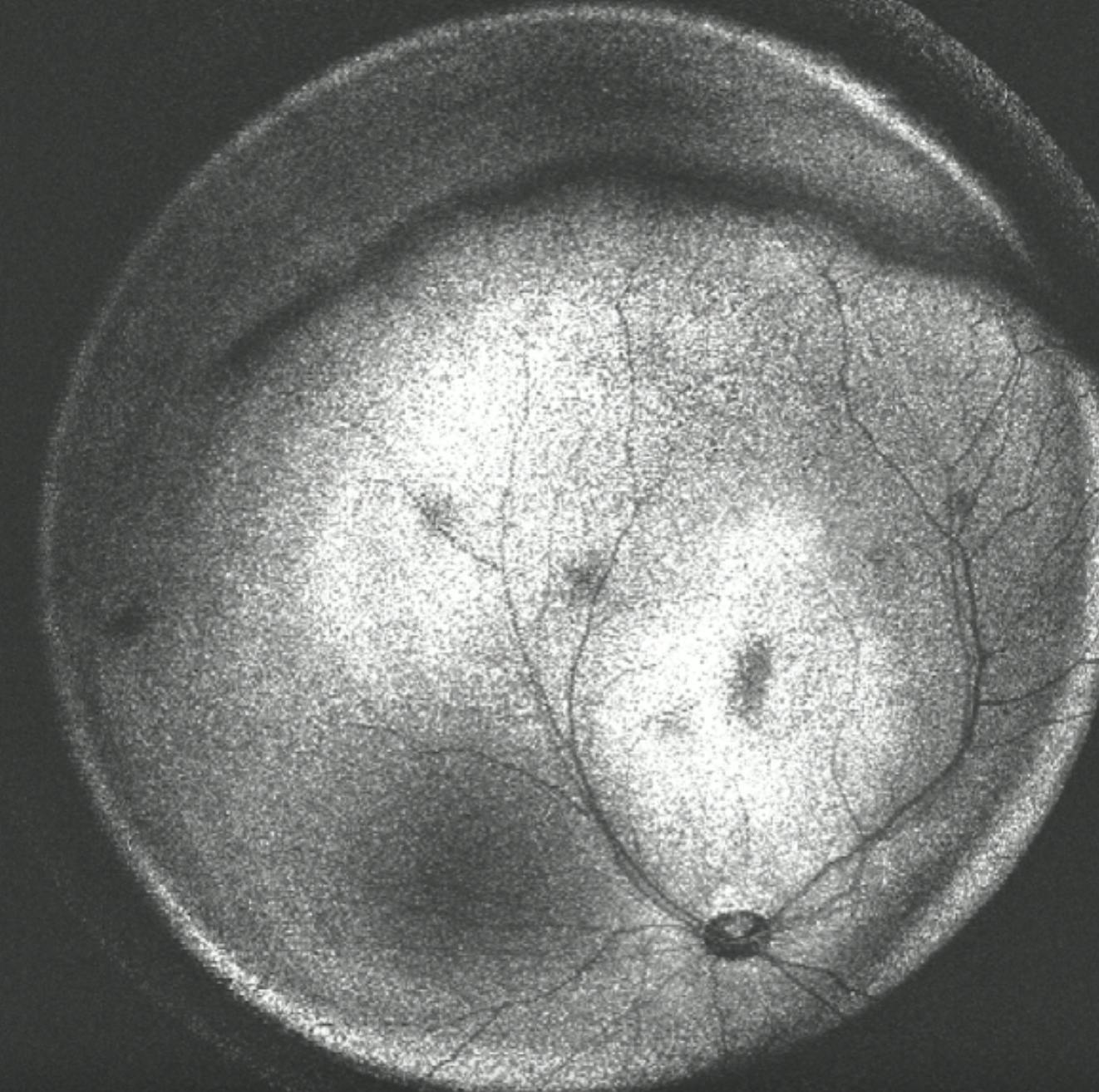 Imaging Advances and Applications for ROP - Retina Today