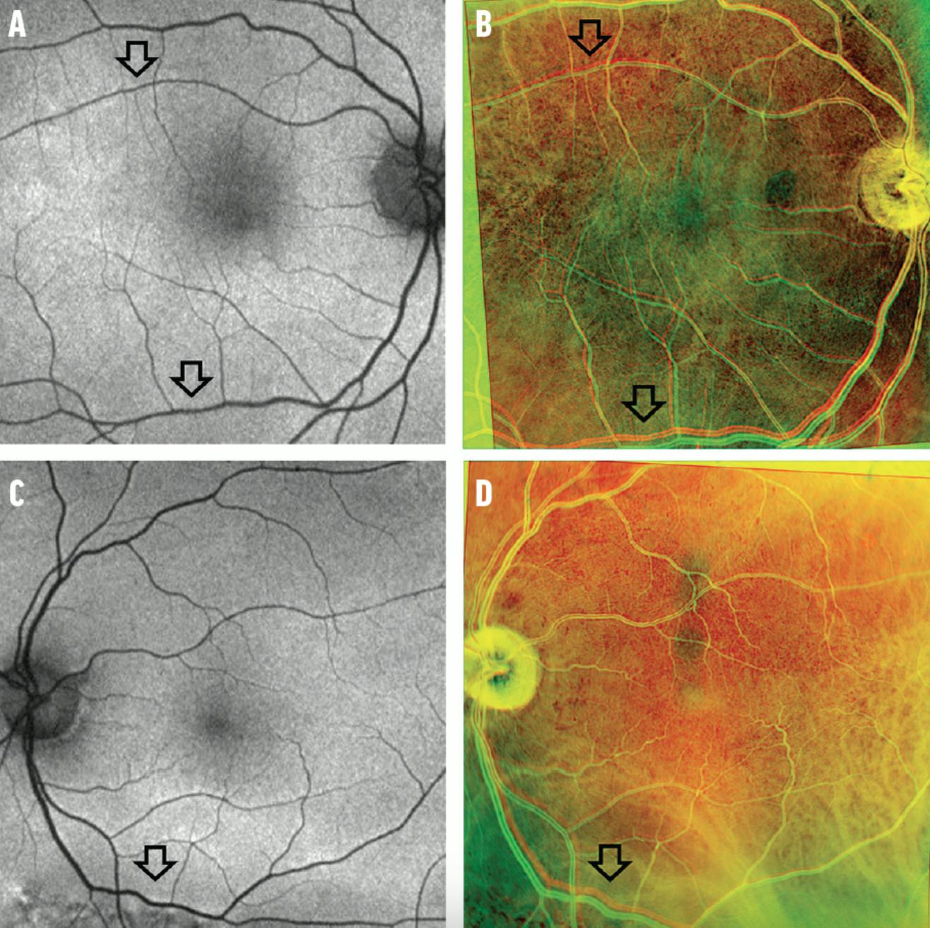 Retinal Displacement on FAF: the Tip of the Iceberg - Retina Today