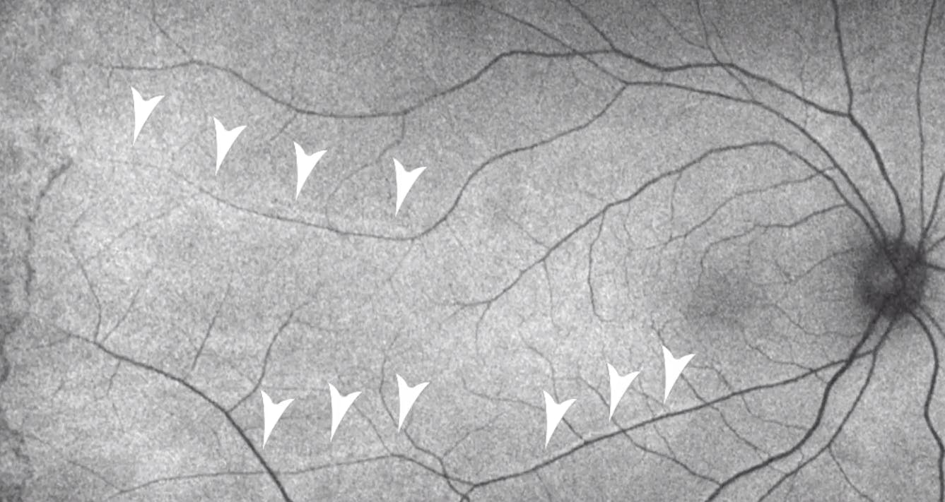 Retinal Displacement on FAF Imaging: The Tip of the Iceberg - Eyetube