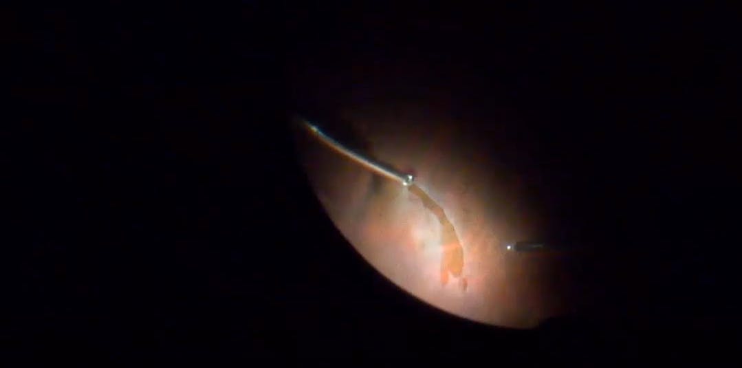 Phakic Vitrectomy for a Posterior Retinal Tear - Eyetube