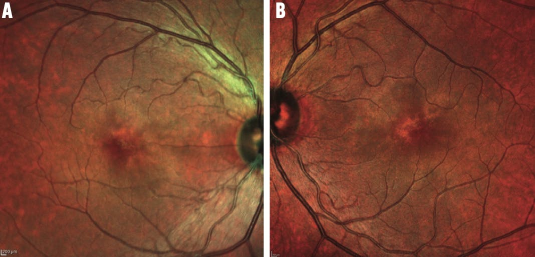 Beware of AMN With COVID-19 Infection - Retina Today
