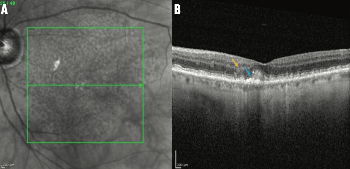 A Look at Novel Geographic Atrophy Biomarkers - Retina Today