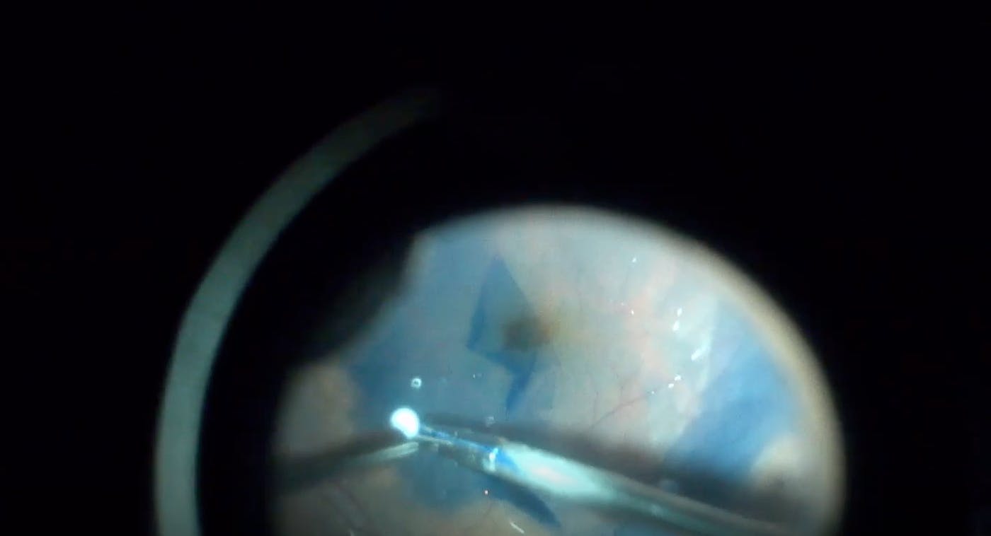High Myopic Retinal Detachment With Macular Hole - Eyetube