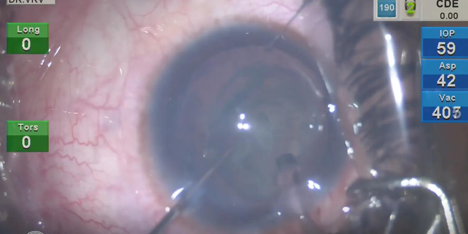 Phacoemulsification in Soft Cataracts - Eyetube