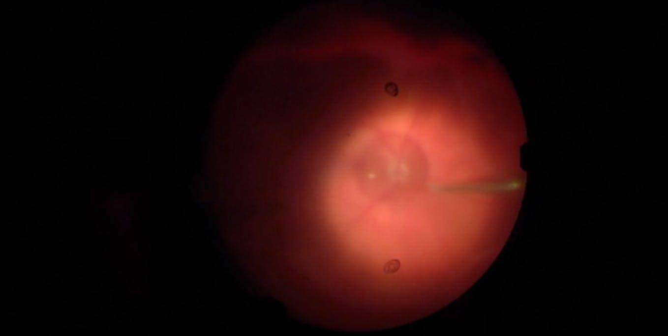 Repairing a Hidden Scleral Rupture - Eyetube