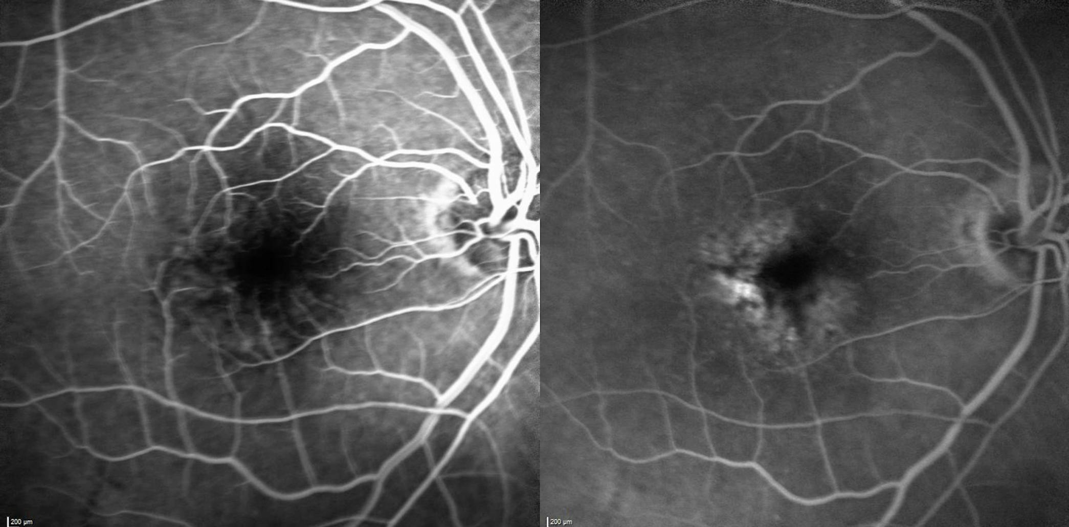 Real-World Treatment-Naïve Case: Bilateral Wet AMD in a 92-Year-Old ...