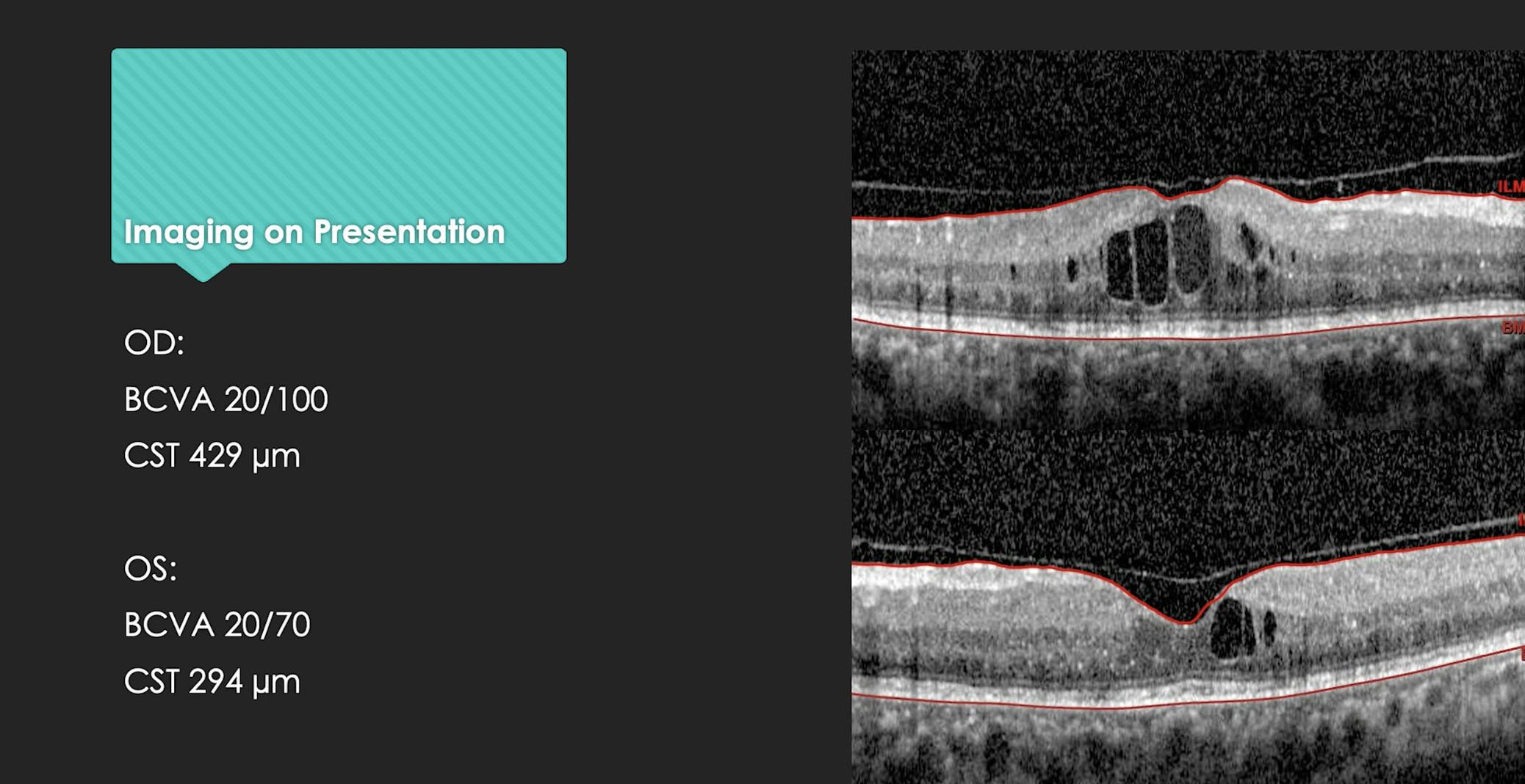 Real-World Step Therapy Case: A Challenging DME Patient - Eyetube