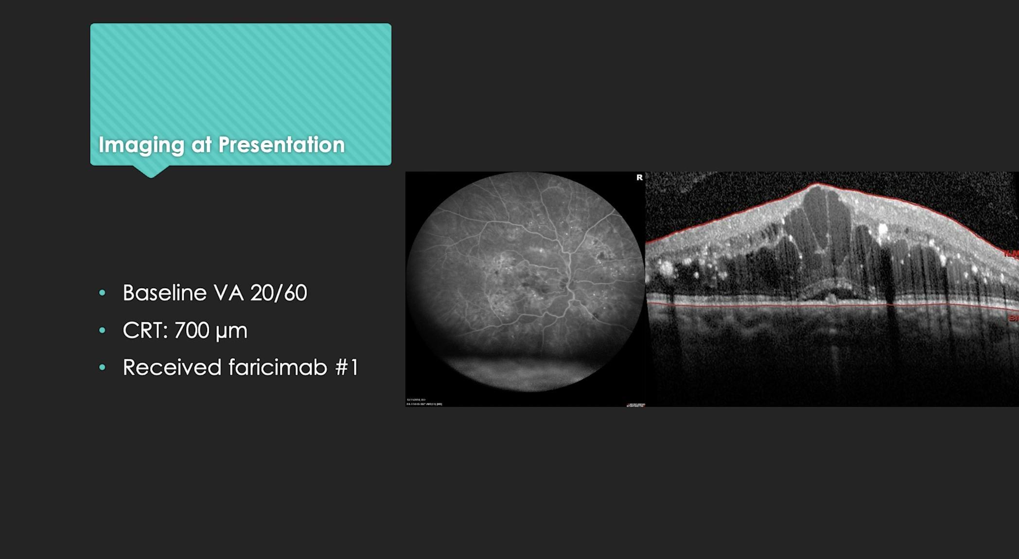 Real-World Treatment-Naïve Case: Treating DME With a Dual-Inhibition ...