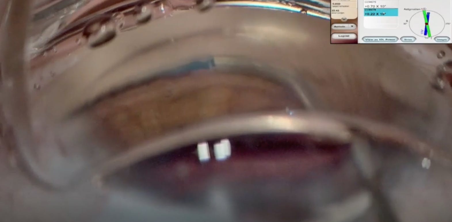 OMNI Trabeculotomy and Viscodilation With Hydrus Implantation - Eyetube