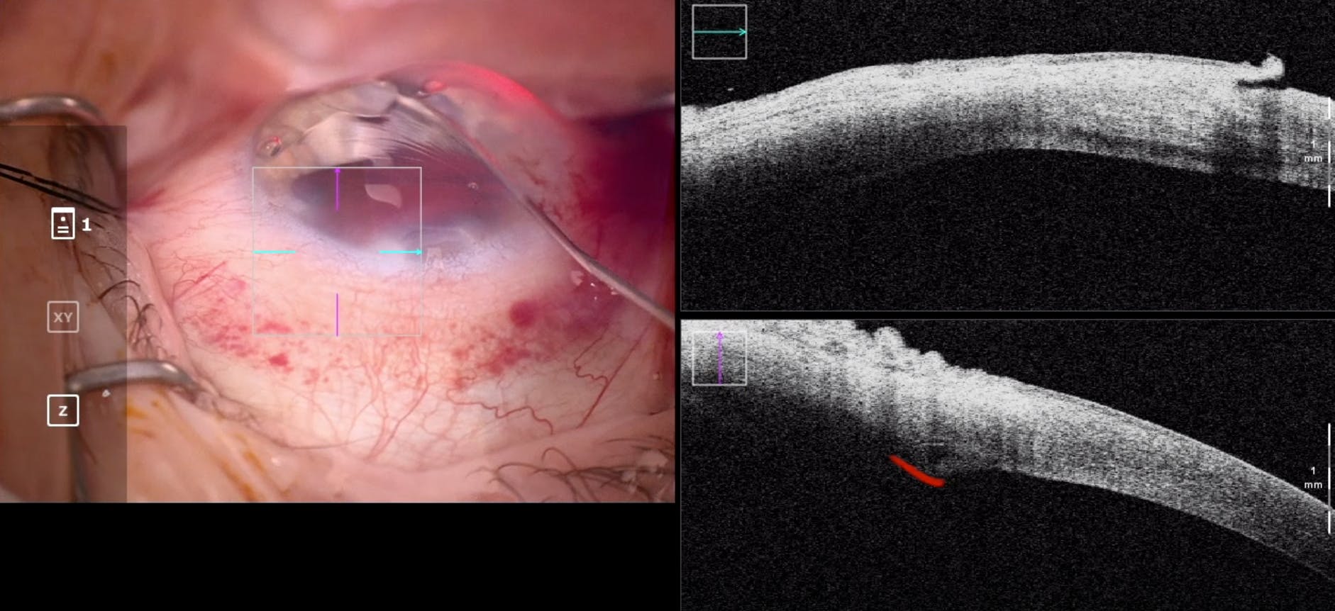 iTrack Advance With Intraoperative OCT - Eyetube