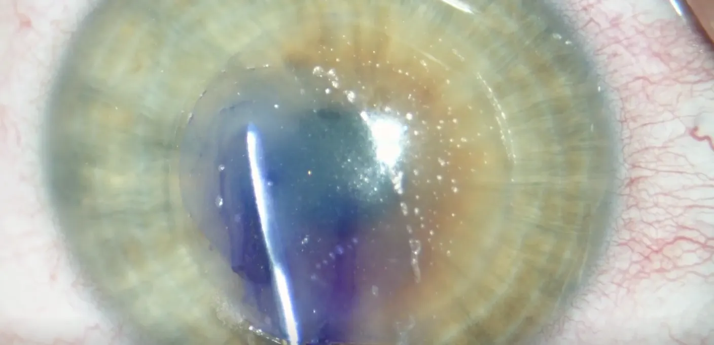 Lenticule Rotation for High Astigmatism - Eyetube