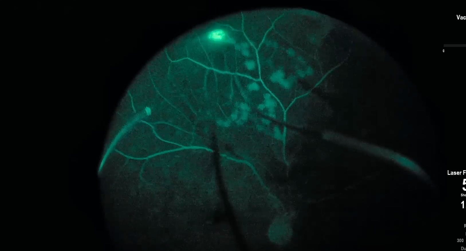 The Utility of Intraoperative Fluorescein Angiography - Eyetube