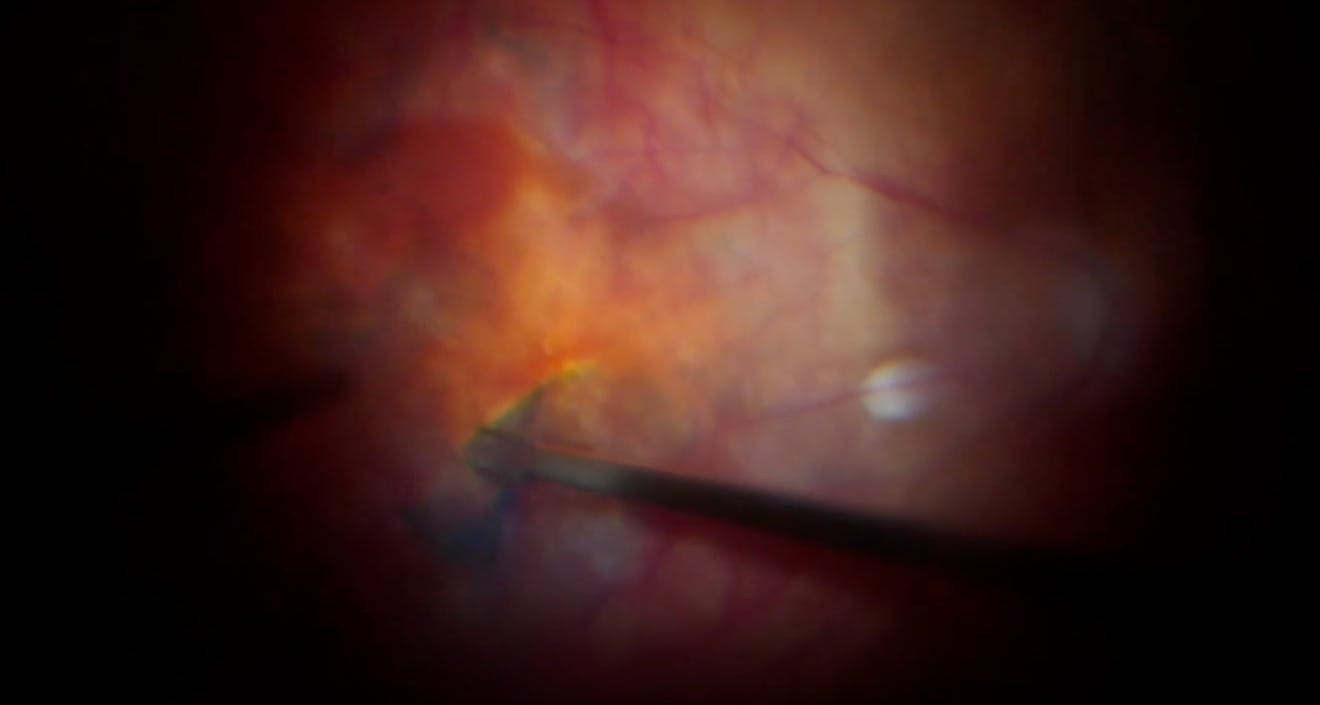 Pars Plana Vitrectomy in Myopic Traction Maculopathy - Eyetube